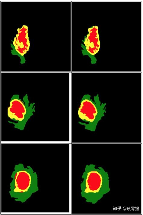 2d Unet Vggblock脑胶质瘤分割brats Pytorch实现脑部多类分割pytorch Csdn博客