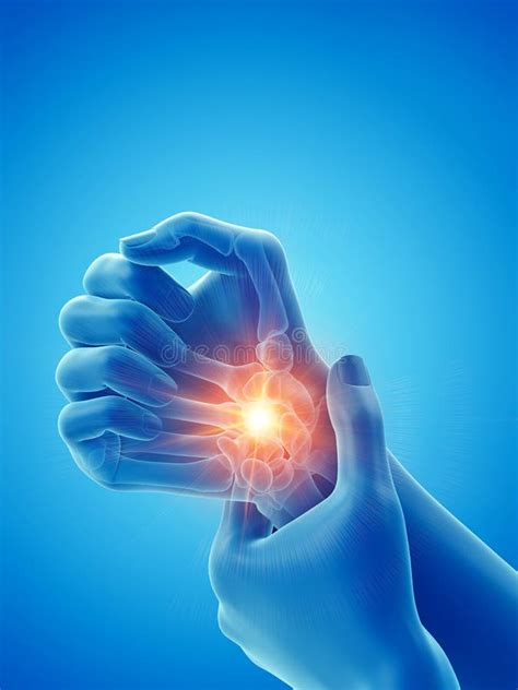 Una Mujer Con Una Mu Eca Dolorosa Stock De Ilustraci N Ilustraci N De Resplandor Osteoporosis