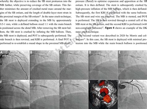Dk Nano Crush Of A Left Anterior Descending First Diagonal Lad D1 Download Scientific