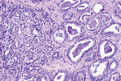 What Is Carcinoma Of The Prostate Dana Farber Cancer Institute