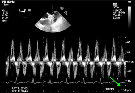 Intraoperative Diagnosis Of Atrial Flutter Using Left Atrial Appendage