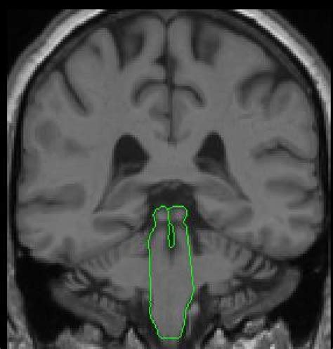 Segmentation Brainstem