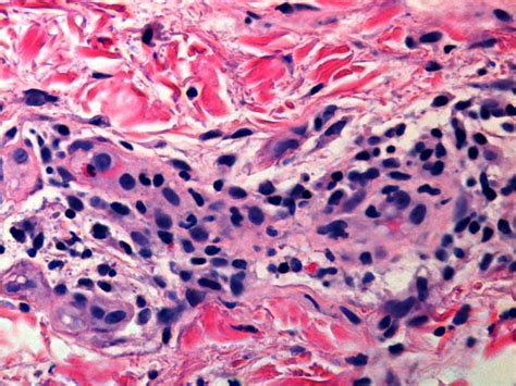 Pruritic Urticarial Papules And Plaques Of Pregnancy Wholly Abated With One Week Twice Daily