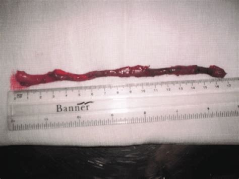 The Long Appendix After Dissection Download Scientific Diagram