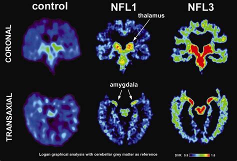 What To Know About Cte Brain Disorder