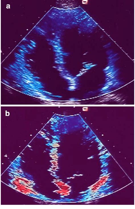 Two Dimensional Acceleration Mode Tdi Images At Four Chamber View A