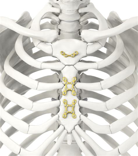 Sternal Plating System Sternum Fixation Tradekorea