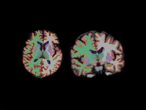 Cortical And Subcortical Structure Segmentation With Freesurfer 51