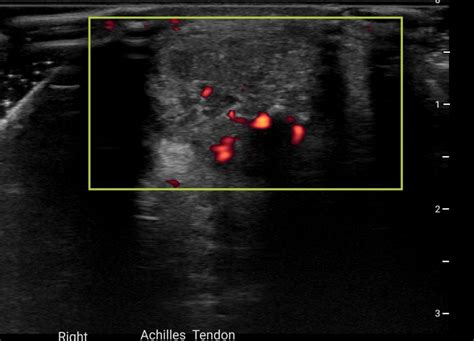 Achilles Tendon Tear Ultrasound