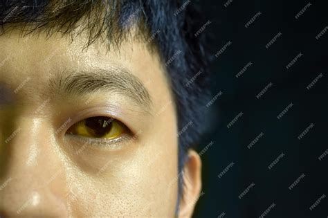 Premium Photo Deep Jaundice In Asian Male Patient Yellowish