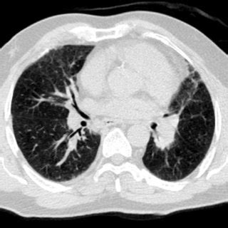 An Image From A Ct Chest Scan Displaying The Use Of Clahe Adapthisteq