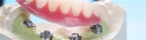 How Many Dental Implants Needed Implant Fixed Bridge Implant Denture