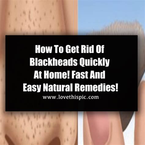 How To Get Rid Of Blackheads Quickly At Home Fast And Easy Natural