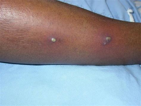 Folliculitis Thighs