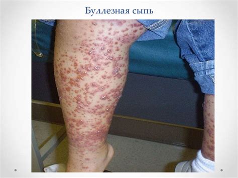 Геморрагический васкулит Online Presentation