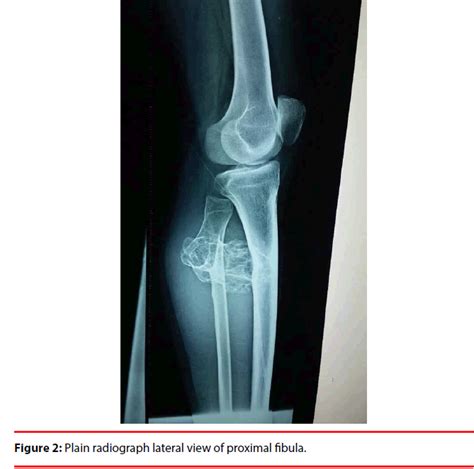 Giant Osteochondroma Of The Proximal Fibula A Rare Case