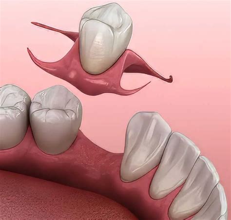 Single Tooth Partial Denture Skyrise Dental Clinic