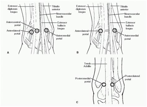 Arthroscopy Of The Ankle And Foot Musculoskeletal Key