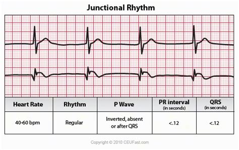Ekg Ecg Interpretation Course Ceufast Nursing Continuing Education