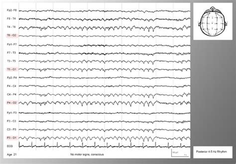Benign Epileptiform Variants Flashcards Quizlet