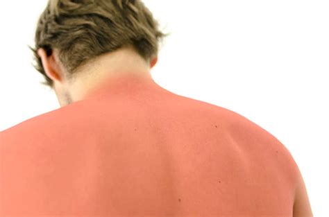 Can You Spot The Difference Between A Sunburn And A Sun Rash Healthy