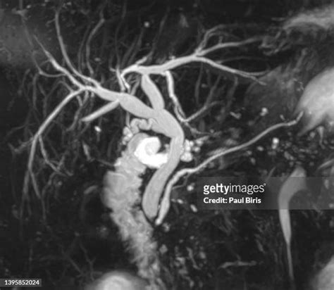 Liver Bile Ducts Photos And Premium High Res Pictures Getty Images