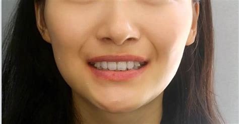 合肥牙齿矫正大概要花费多少钱 我的深覆合、高虎牙、错位牙做全隐形矫正才花了 知乎