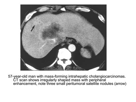 Diagnostic Imaging Of Cholangiocarcinoma Ppt
