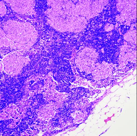 Hematoxylin And Eosin Stained Section ×10 Of Right Level V Cervical