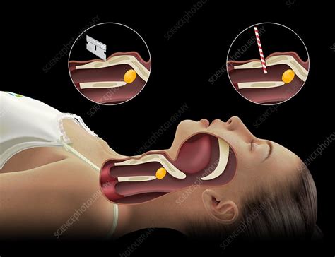 Emergency Tracheotomy Illustration Stock Image C046 6552 Science