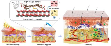 Microneedle Patch Teams Up With Ultrasound To Kill Acne Bacteria