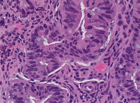 Biopsy Of Sigmoid Mass Showing Moderately Differentiated Adenocarcinoma