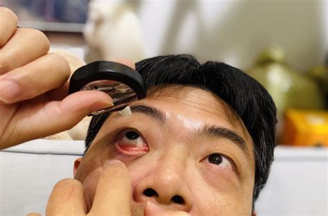 吃炸物、常熬夜讓針眼上身 藥師揭5招加速消退：溫熱濕敷有效 Ettoday健康雲 Ettoday新聞雲
