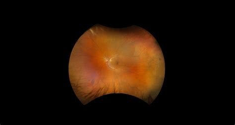 New Optomap Ultra Widefield Colour Image Modality Provides Additional Retinal Visualisation