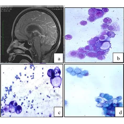 CSF Examination For Malignant Cells Test In Delhi India GDIC