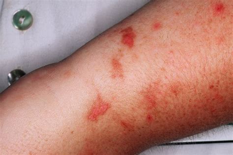 Wild Parsnip Burns Symptoms Treatment Prevention