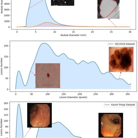 The Distribution Of Lesions With Different Sizes In Several Lesion