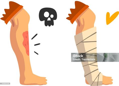 부상 다리 신체 부상 붕대 다리 응급 처치 및 치료 벡터 일러스트 레이 션 흰색 바탕에 개념에 대한 스톡 벡터 아트 및 기타