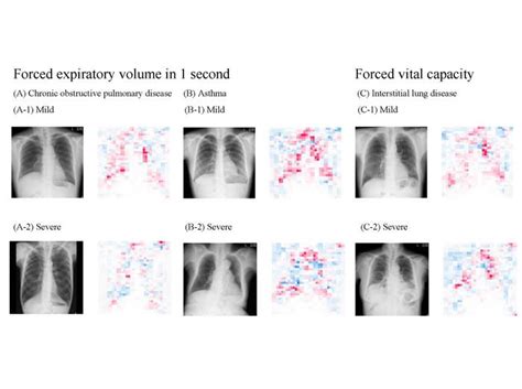 AI Model Estimates Lung Function From Chest X Rays Technology
