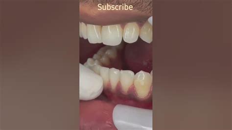 Interproximal Slicing Interproximal Slicing Ortho Shortsvideo Youtube