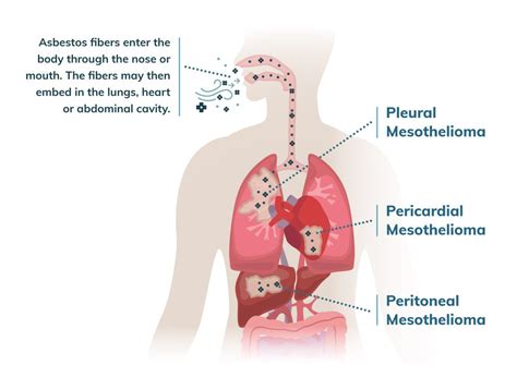 Mesothelioma Causes And Risk Factors