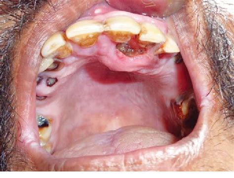 Figure 3 From Maggots In The Mouth— Oral Myiasis A Rare Case Report