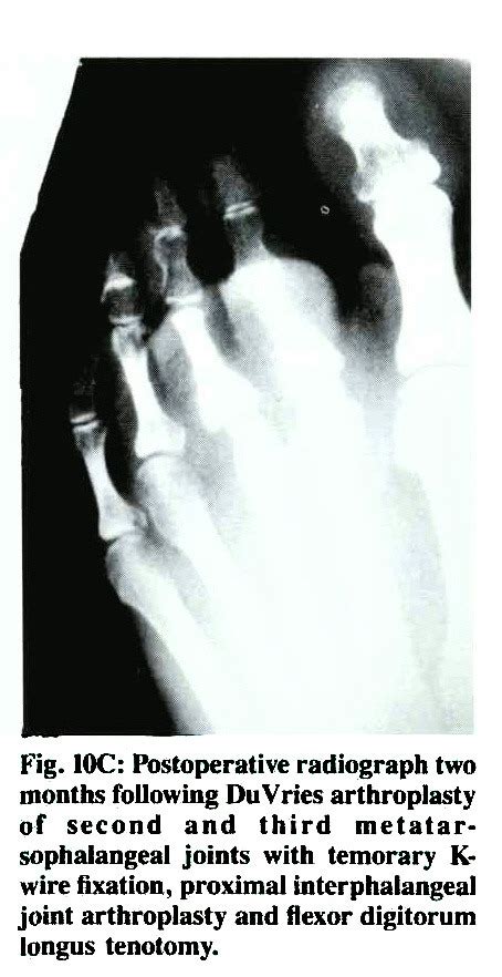 Problems Of The Second Metatarsophalangeal Joint
