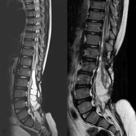 Chiari Type I Malformation Tonsillar Herniation Syringomyelia Before