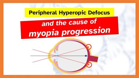 Peripheral Hyperopic Defocus And The Cause Of Myopia Progression Explained Youtube