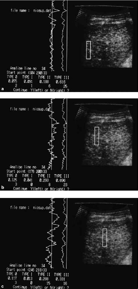 Figure 1 From Irregularity Of Parenchymal Echo Patterns Of Liver