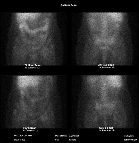 Days Of Our Lives Australian Version Gallium Scan Results