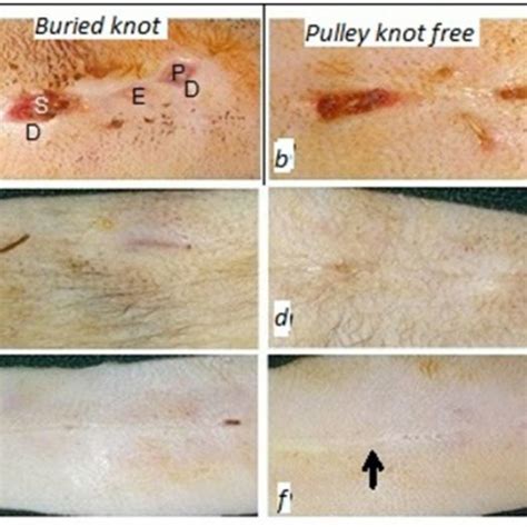 Two Methods Of Anchoring The Continuous Intradermal Suture Pattern Download Scientific Diagram