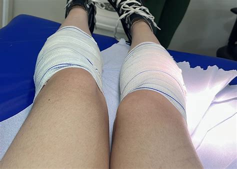 Fans Suffered From Second Degree Burns” At Taylor Swifts Show Where