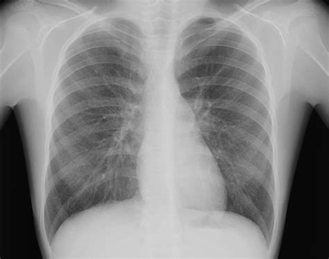 Diffrence Entre Radiographie Pulmonaire Et Mri Heju Blog Deco